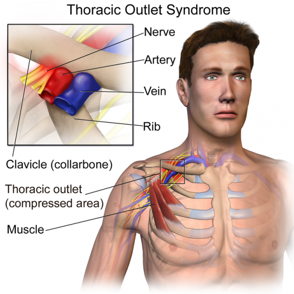 Thoracic Outlet Syndrome (TOS), here’s what you need to know ...